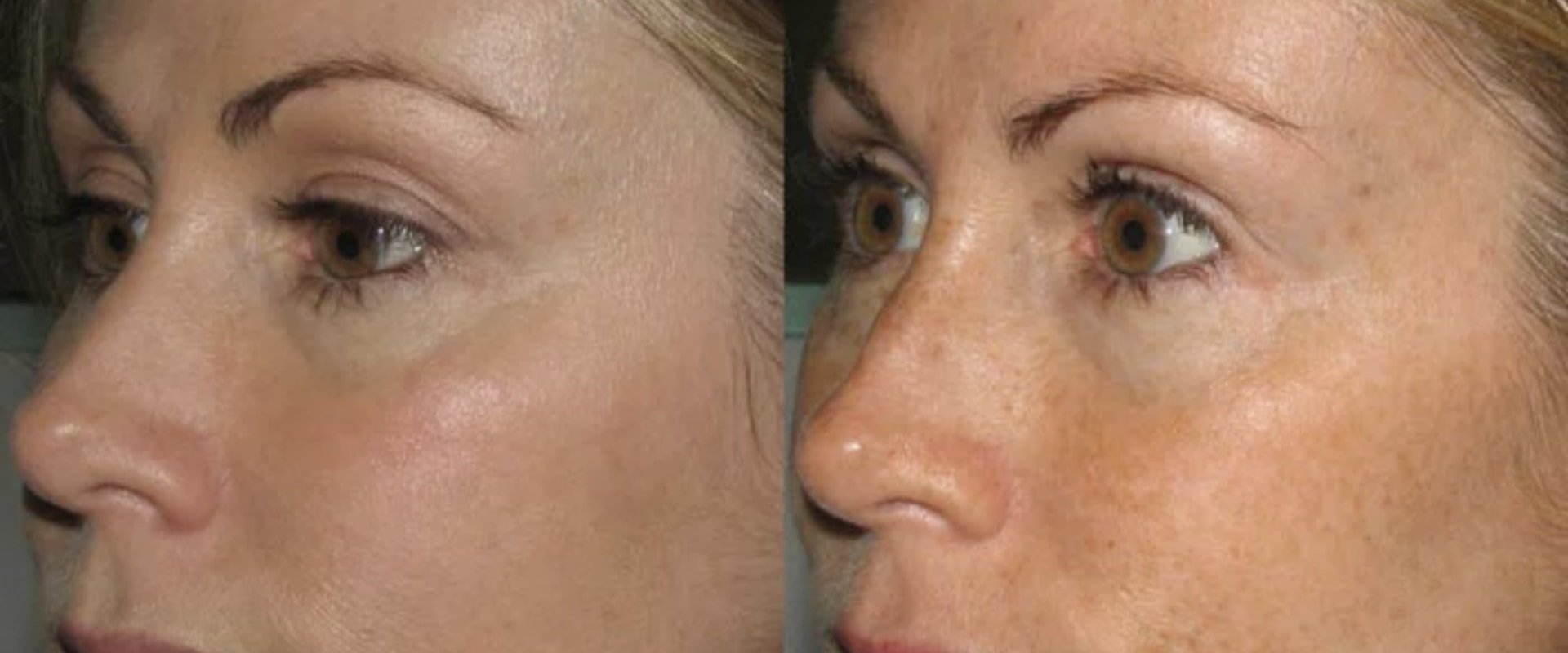 What is IPL Treatment and How Does it Work?