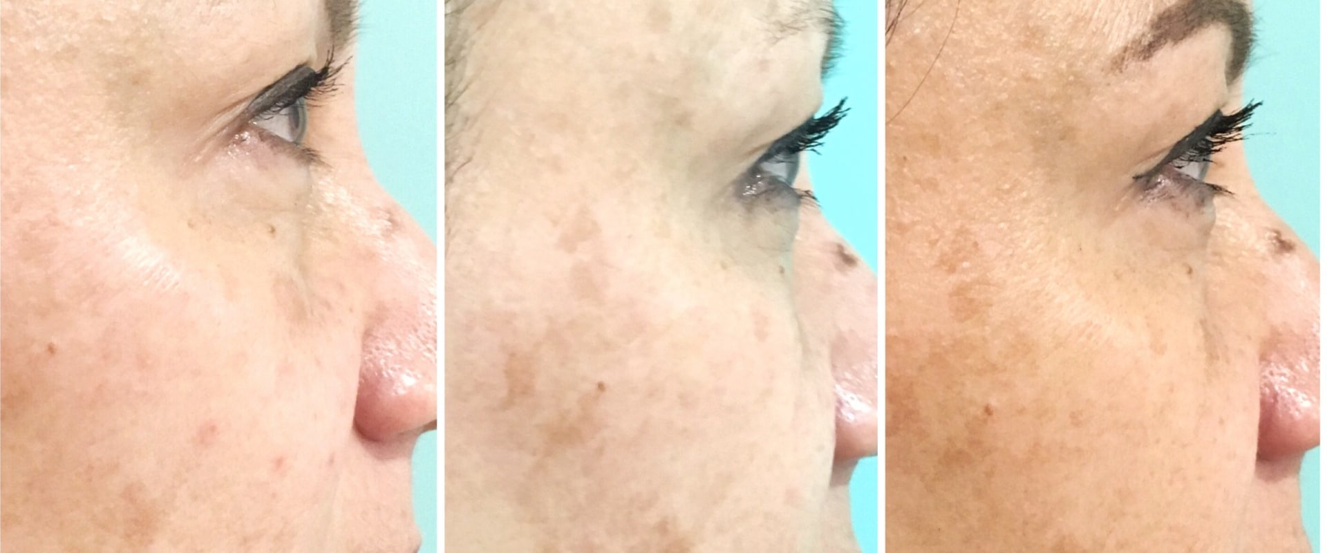 What are the Benefits of IPL Treatment?