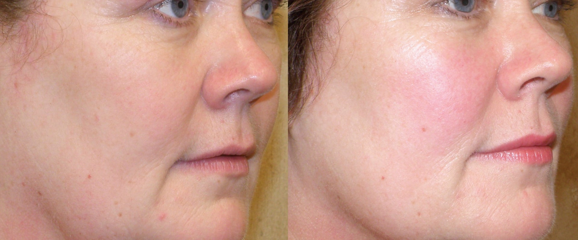 What is IPL treatment for?